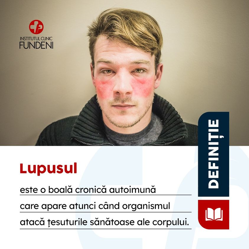 Institutul Clinic Fundeni: Lupusul, greu de diagnosticat. Simptomele ...