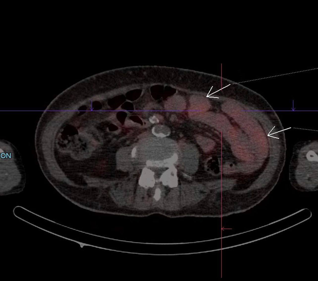 SUUB: Scintigrafia cu Tektrotyd – metodă esențială în diagnosticul ...
